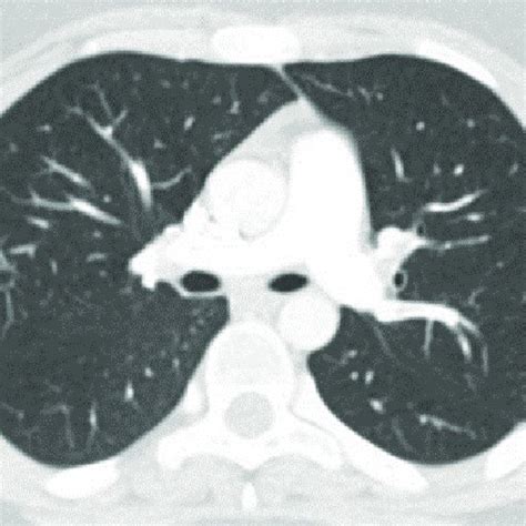 Total Body Ct Scan Documented Diffuse Pulmonary Embolism Download