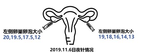 降调促排 降调促排方案 四川锦欣西囡妇女儿童医院 毕昇院区 成都健康好孕网