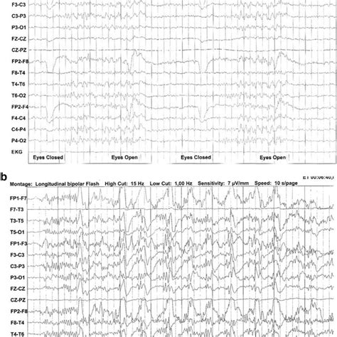 A Brief Generalized Discharges Of Spikes Polyspike Waves Occurring