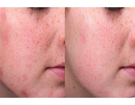 Rhinophyma Rosacea Cutis Dermatology