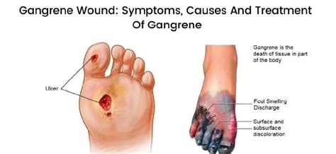 Gangrene Types Causes Symptoms Gangrene Treatment Methods