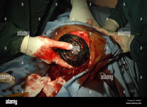 C Section Surgery Procedure Steps