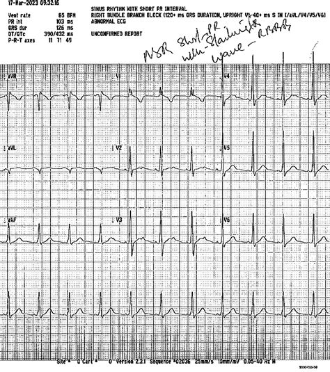 Echo Results Should I Be Worried Raskcardiology