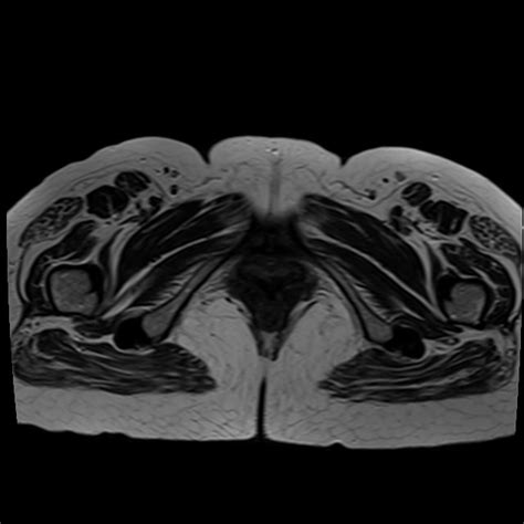 Bilateral Tubo Ovarian Abscesses Radiopaedia 58635 65829 Axial T2
