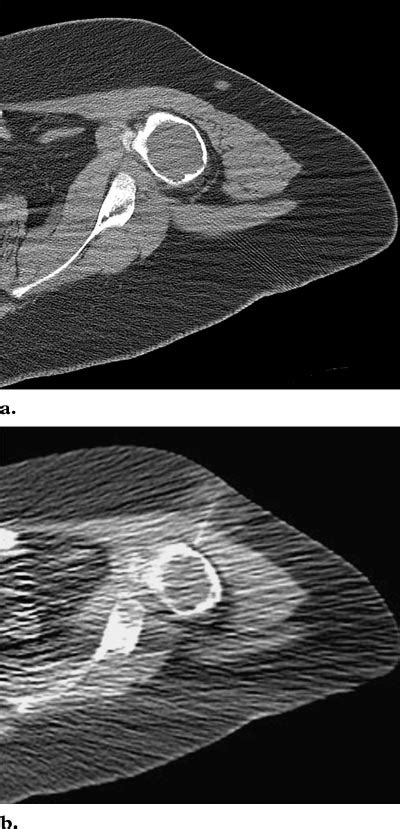Chondromyxoid Fibroma Of The Proximal Left Humerus In A 21 Year Old Download Scientific Diagram