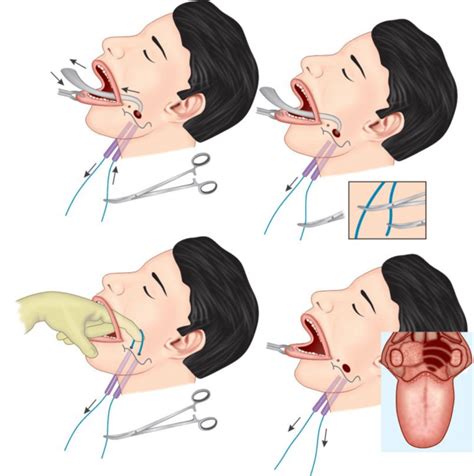 24 Loop Technique Of Implant Download Scientific Diagram