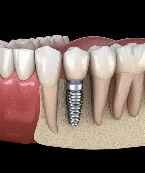 Advanced Dental Implant Crowns And Bridges 🌱 Integrative Dental Care