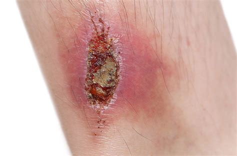 Peradangan Pada Kulit Ini 4 Gejala Pyoderma Gangrenosum