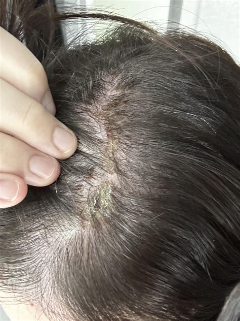 Picking Scalp Causing Scabs Need Help Rcalmhands