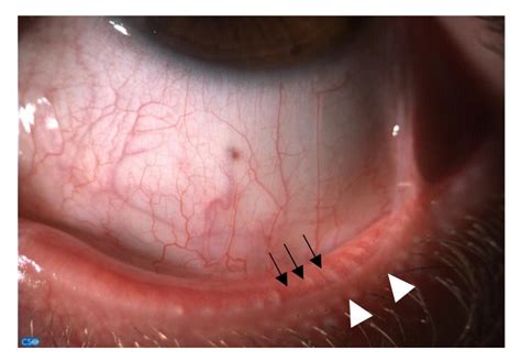 Sex Hormones Related Ocular Dryness In Breast Cancer Women Pmc