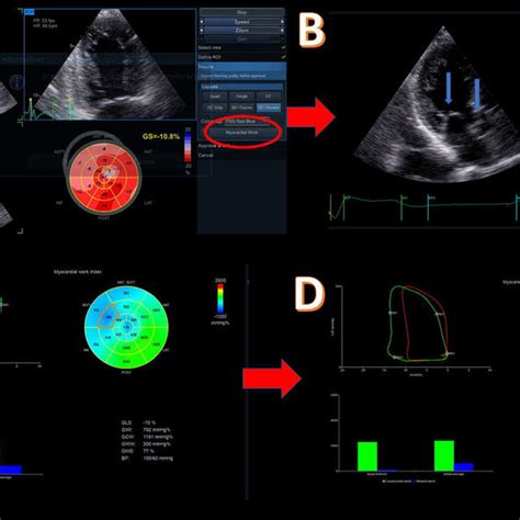 Pdf Myocardial Work Methodology And Clinical Applications