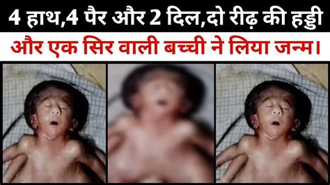 4 हाथ 4 पैर2 दिल और एक सिरमहिला ने दिया विचित्र बच्ची को जन्मदेखने