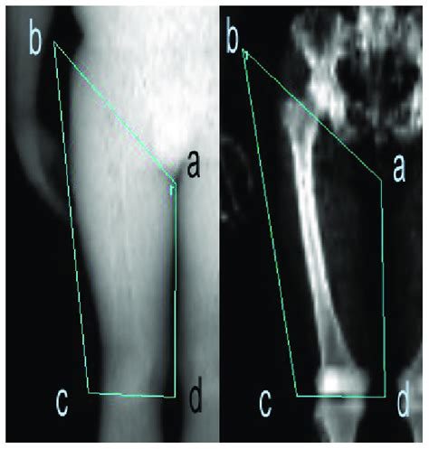 Example Of Dexa Scan Image Of Right Thigh A Four Sided Polygon Was