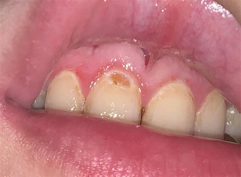 Is This A Cavity Tooth Decay Or Something Else It Doesnt Hurt But