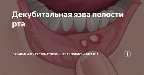 Декубитальная язва полости рта | Балашихинская стоматологическая ...