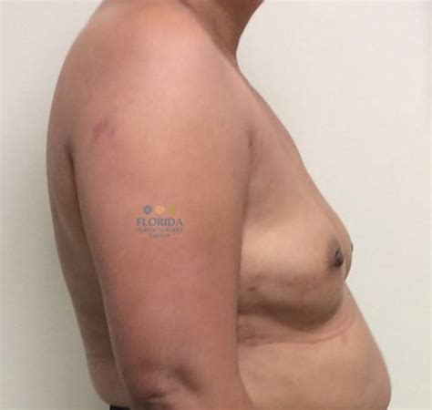 Patient 154948886 Tissue Expander Reconstruction Before And After