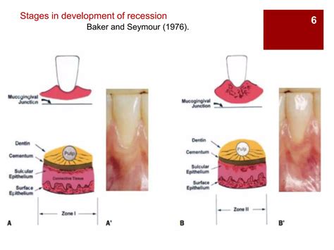 Root Coverage Procedures Dr Kinjal Ghelani Pptx