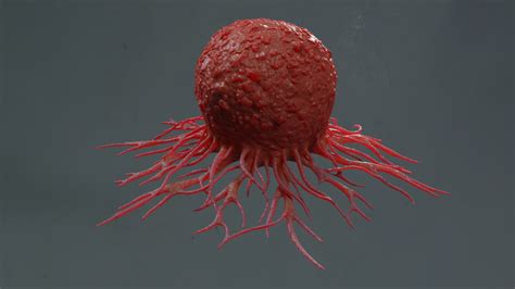 Tumors 3d Model Turbosquid 2159319