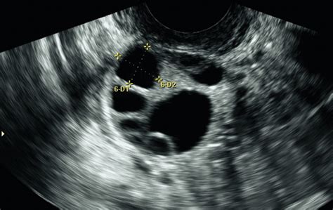 Graafian Follicle Ultrasound