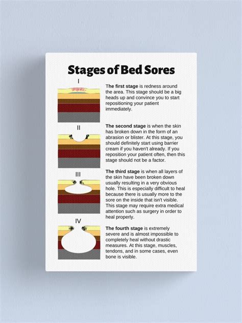 Stages Of Bed Sores Chart Poster By Caregiverology Bed Sores Porn Sex