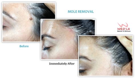 Cancerous Mole Removal