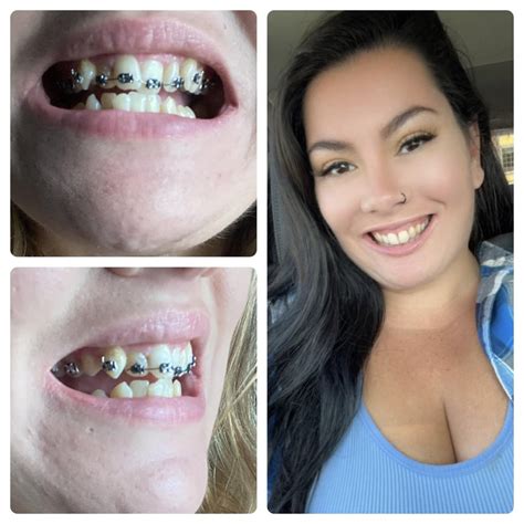 Glue Staining R Braces