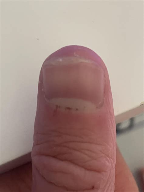 Staining On Thumb Cuticle Concerning Rdermatologyquestions