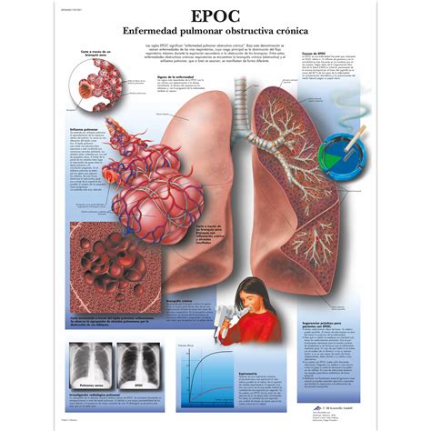 EPOC Enfermedad pulmonar obstructiva crónica 1001851 3B Scientific