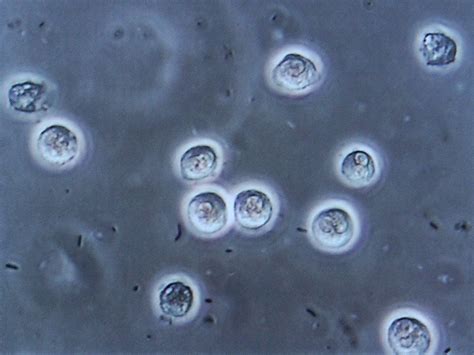 Uti Versus Asymptomatic Bacteriuria In Long Term Care