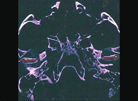 A And B A Axial CBCT Image Of The TMJ Showing Greatest Mediolateral