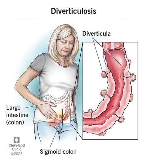 Acute Diverticulitis