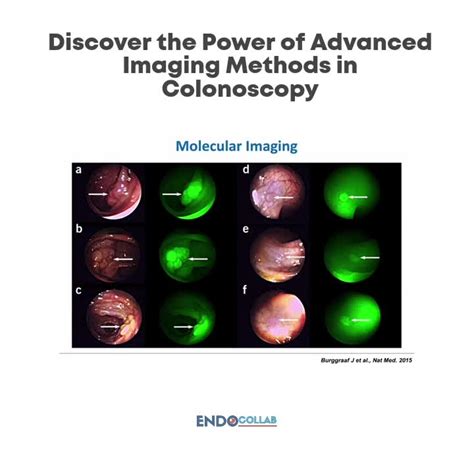 Advanced Colonoscopy Imaging Advanced Imaging Techniques Enhance