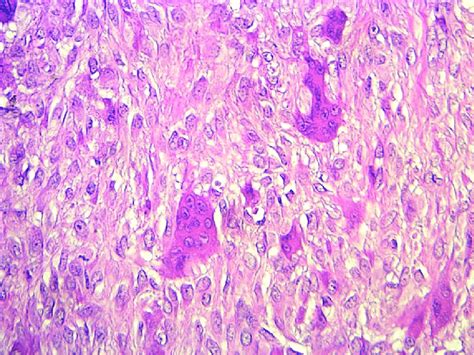 Multinucleated Giant Cell In The Stroma Hematoxylin Eosin He 400x