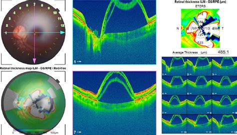 Preoperative Oct Showing With Retinoschisis Odp M Optic Disc