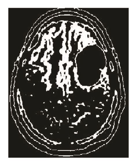Segmented And Area Extracted Result Of Brain Mr Image A Original Download Scientific Diagram