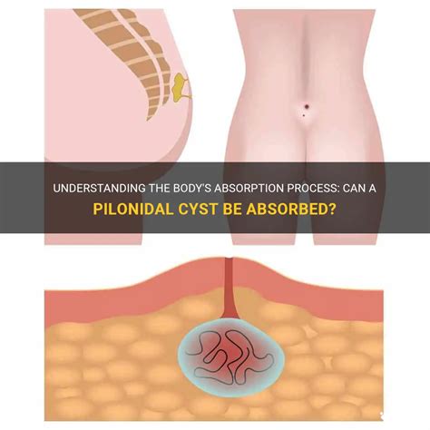 Understanding The Bodys Absorption Process Can A Pilonidal Cyst Be Absorbed Medshun