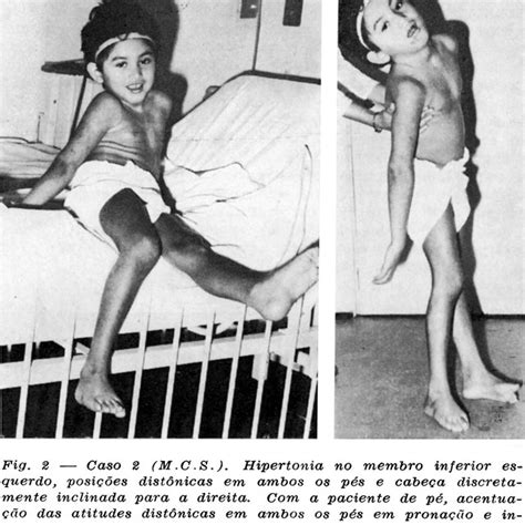 Pdf Dystonia Musculorum Deformans Report Of Three Cases