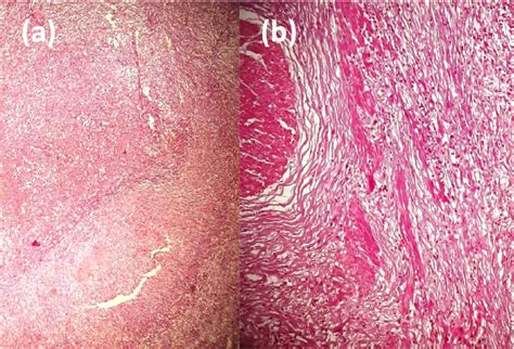 A Polymorphous Suppurated Inflammatory Infiltrate ×40 B
