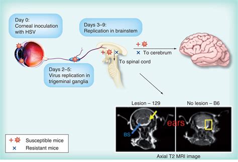 The Case For Immunomodulatory Approaches In Treating Hsv Encephalitis