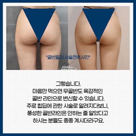 골반필러·힙딥필러·가슴필러·두상필러·어깨필러 강남역 바디필러