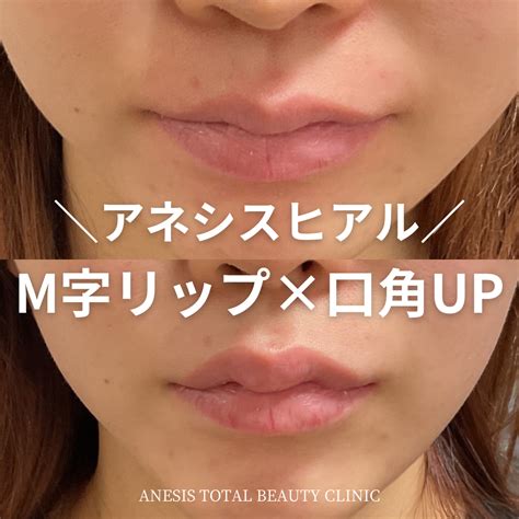 口唇haのモニター紹介 アネシス美容クリニックのブログ