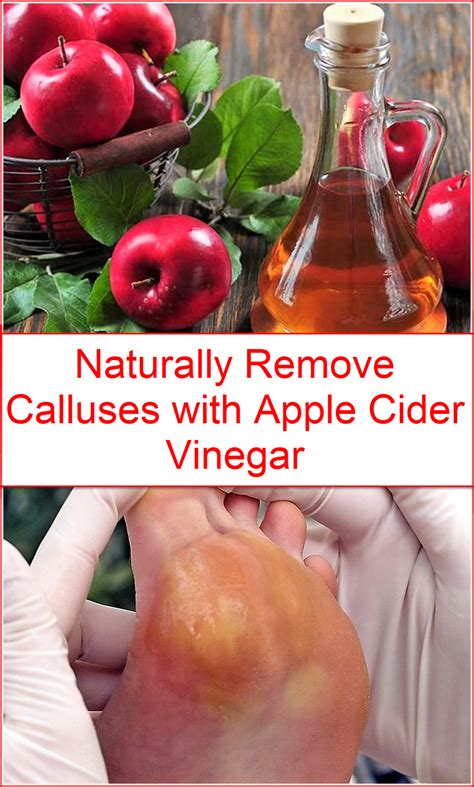 Vinegar Foot Soak For Swelling Listerine Foot Soak