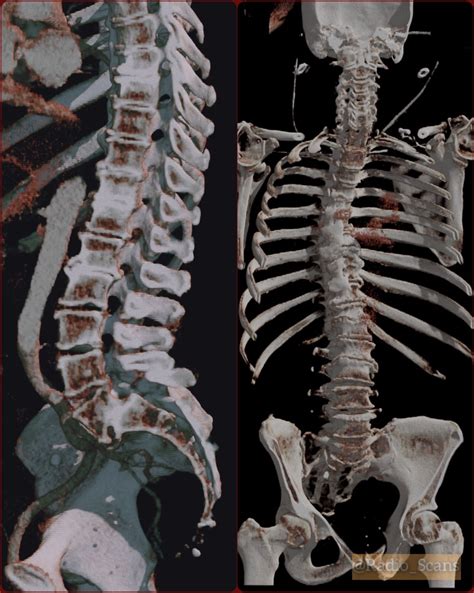 Radiology Medicine Ct Ctscan Medicalimaging Anterolisthesis