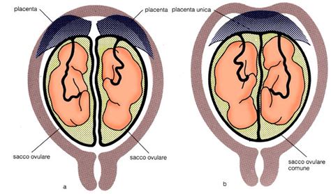 Differenza Tra Monozigote E Dizigote Bald Mountain Science