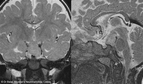 Dr Balaji Anvekar Frcr Hypothalamic Hamartoma Presenting With