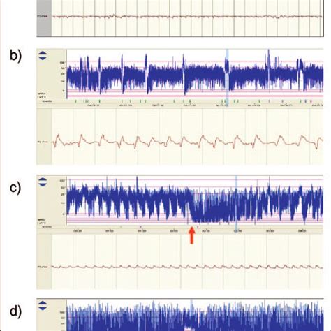 The Classification Of Primary Aeeg Background Patterns As Well As The