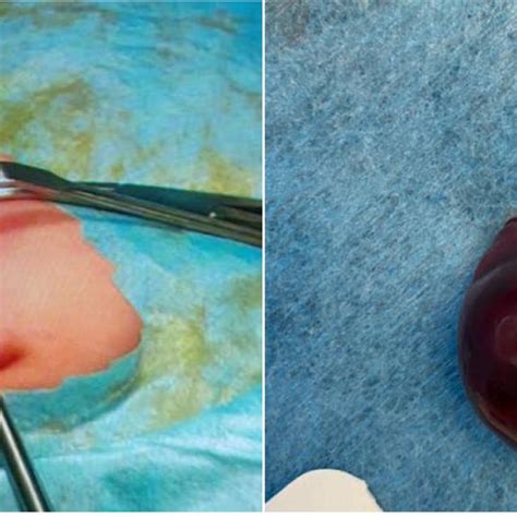 A The Herniotomy Procedure Showing Gangrenous Fallopian Tube B