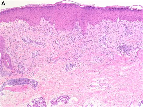 Beyond Sweet Syndrome Surgical Pathology Clinics