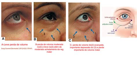 Preenchimento Malar ClÍnica Bella Pelle