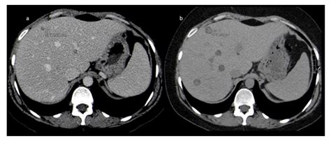 A Case Report Of Unusual Appearance Of Multifocal Nodular Fatty Liver Infiltration With